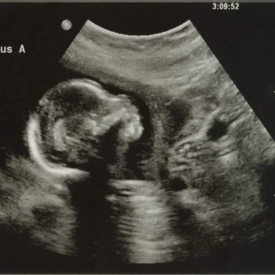Book Ultrasound Level-II-Twins Test in Yamuna Vihar