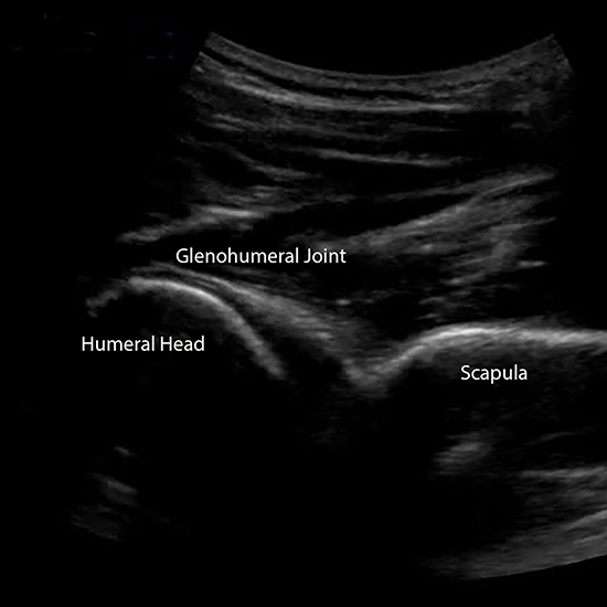 Shoulder Ultrasound Test Procedure