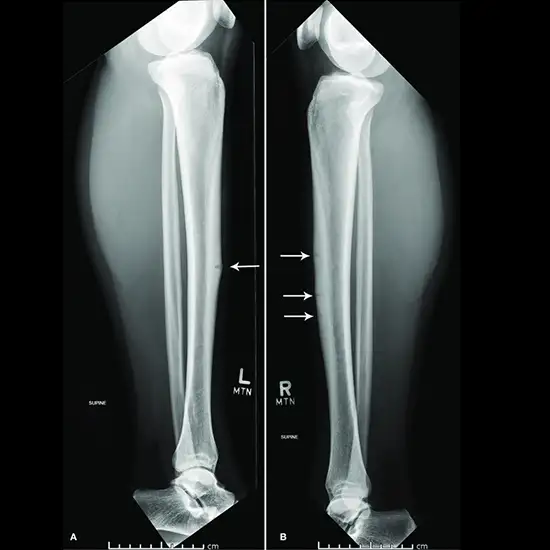 X-Ray Tibia AP and Lateral View | Test Price in Delhi | Ganesh Diagnostic