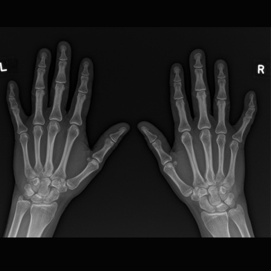 X-Ray Both Hand PA View | Test Price in Delhi | Ganesh Diagnostic