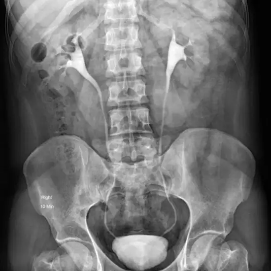 Intra-Venous Urography (IVU) | Test Price in Delhi | Ganesh Diagnostic