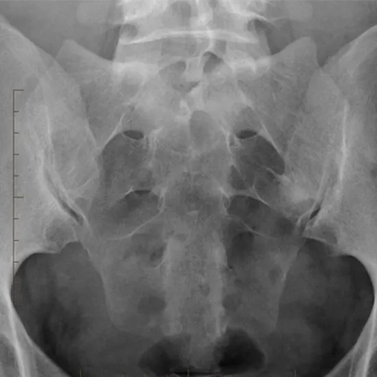 X-RAY SI Joint AP View | Test Price in Delhi | Ganesh Diagnostic