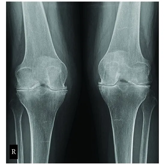 X Ray Both Knee Tunnel View | Test Price in Delhi | Ganesh Diagnostic