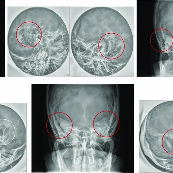 X-Ray Right Ear AP and Lateral View | Test Price in Delhi | Ganesh ...