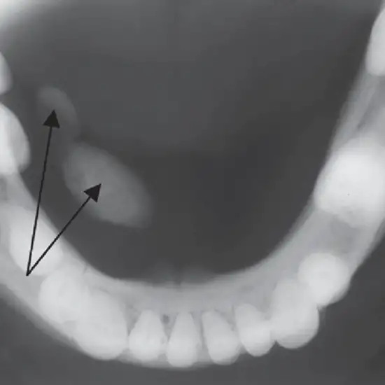 X-Ray Right Submandibular Occlusal View | Test Price in Delhi | Ganesh ...