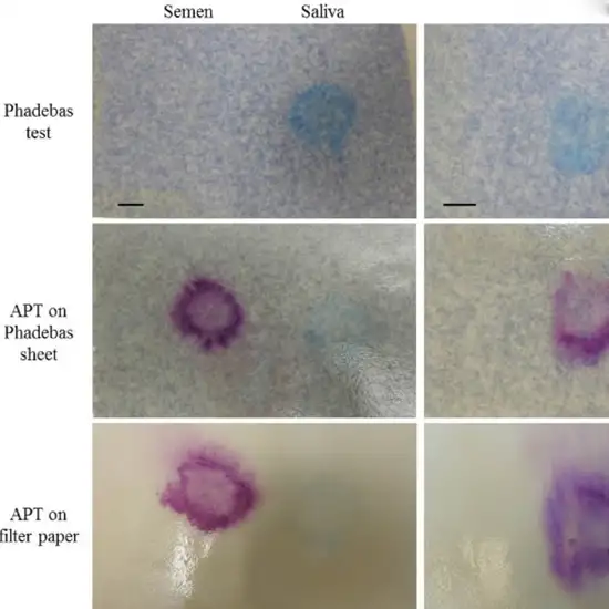 Acid Phosphatase, Total Test Near You in Delhi | Book Test at Low Price