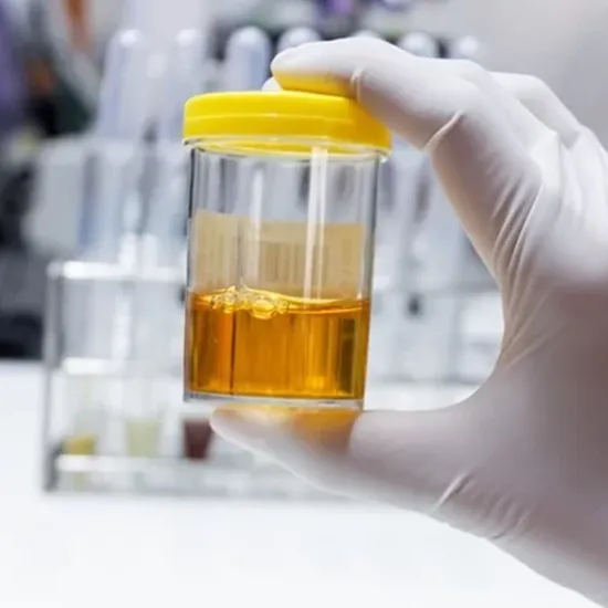 Book Urine Protein Creatinine Ratio | Test Price In Delhi, India ...