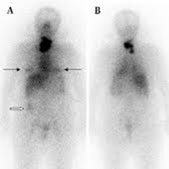 Iodine Whole Body Scan | Test Price In Delhi | Cost Near Me, India ...
