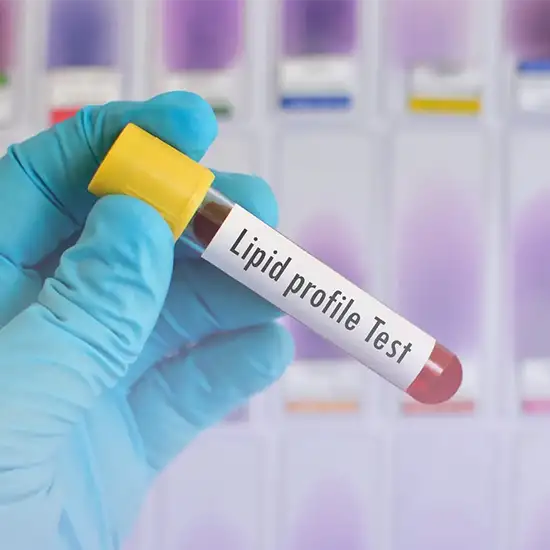 Book Lipid Profile Complete | Test Price In Delhi | Ganesh Diagnostic