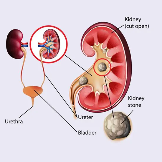 Kidney Stone Formation Test - Book at an Affordable Price