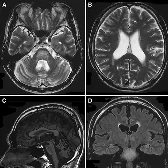 Book DRPL (Dentatorubral-pallidoluysian Atrophy) Analysis | Test Price ...