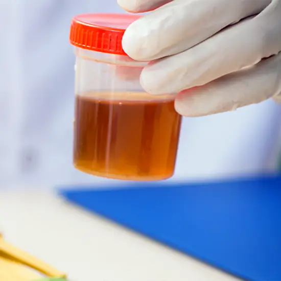 Organic Acids Urine Test Near You in Delhi | Book Test at Low Price