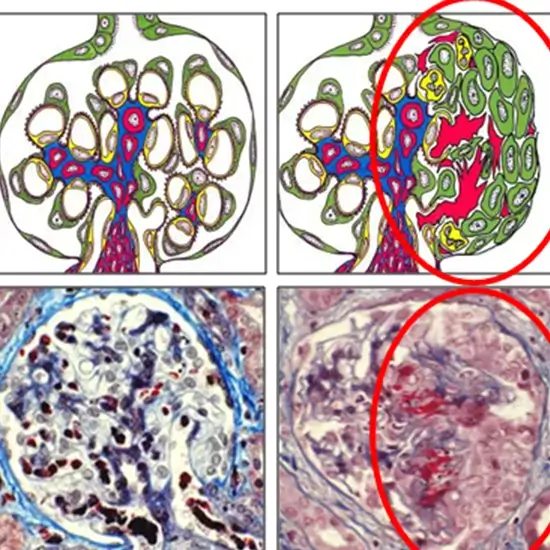 Vasculitis Panel | Test Price In Delhi | Cost Near Me, India | Ganesh ...
