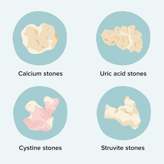Stone Analysis With Picture | Test Price In Delhi | Cost Near Me, India ...