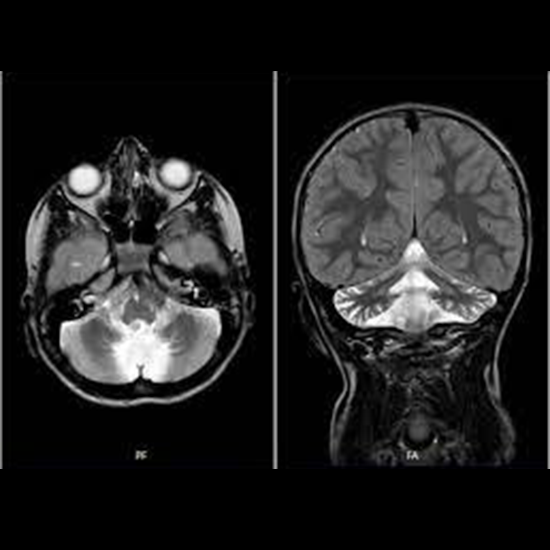 SCA-5 (Spinocerebellar Ataxia): SPTBN2 Gene Mutation Test Near You in ...