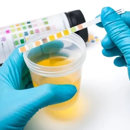 Urine Reducing Substances | Test Price In Delhi | Cost Near Me, India ...
