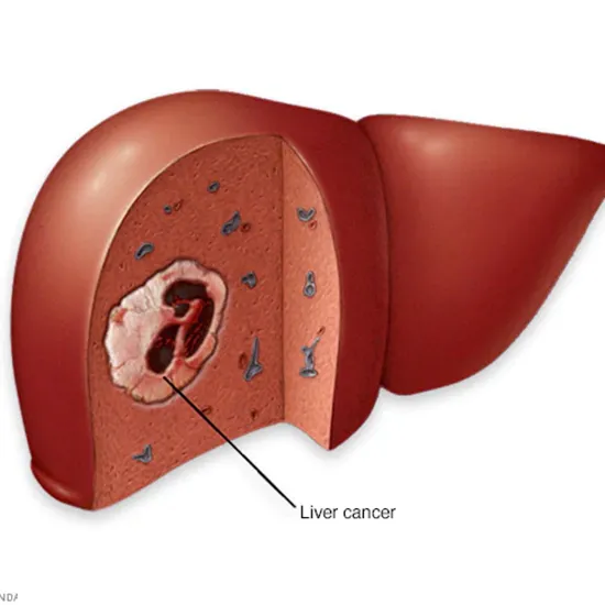 Hepatocellular Carcinoma (HCC) Panel | Test Price In Delhi, India ...