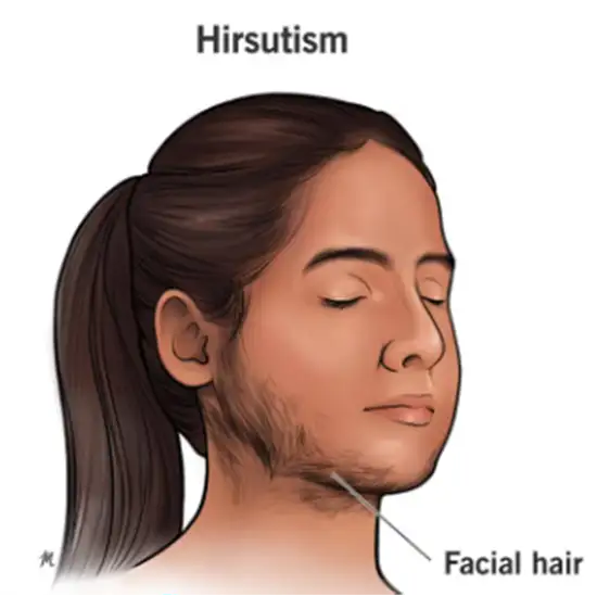 Hirsutism Panel | Test Price In Delhi | Cost Near Me, India | Ganesh ...