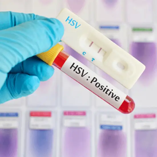 Herpes Simplex Virus (HSV) 1 Antibodies Panel IgG & IgM, Serum Test ...