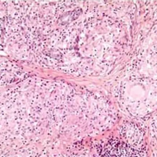 Histopathology Biopsy: Large Complex/Cancer Specimen Cost in Delhi Test ...