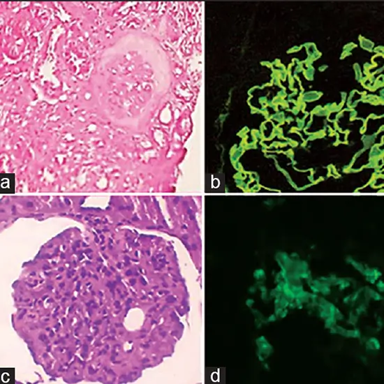 Histopathology Direct Immunofluorescence Renal Biopsy Cost in Delhi ...