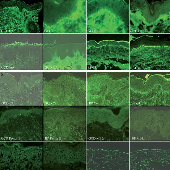 Direct Immunofluorescence Skin Biopsy, Complement C1q Test | Book Test ...