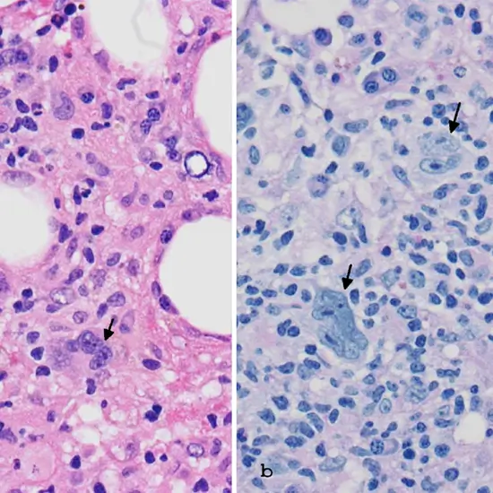 PAS Stain, Blood/Bone Marrow Cost in Delhi Test Price Near Me | GDIC