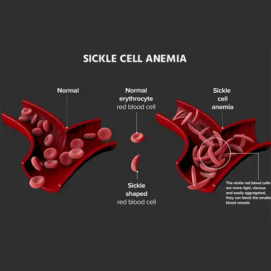 Book Sickle Cell Anemia Mutation Detection | Test Price In Delhi ...