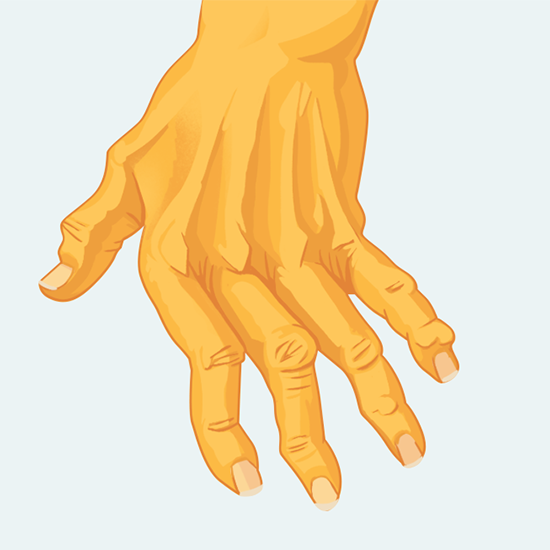 Rheumatoid Autoimmune Comprehensive Panel Test Cost in Delhi | GDIC