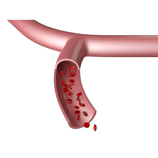 Thrombophilia Profile | Test Price In Delhi | Cost Near Me, India ...