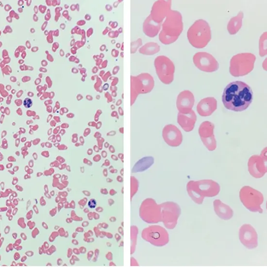 Book Macrocytic Anemia Panel | Test Price In Delhi, India | Ganesh ...