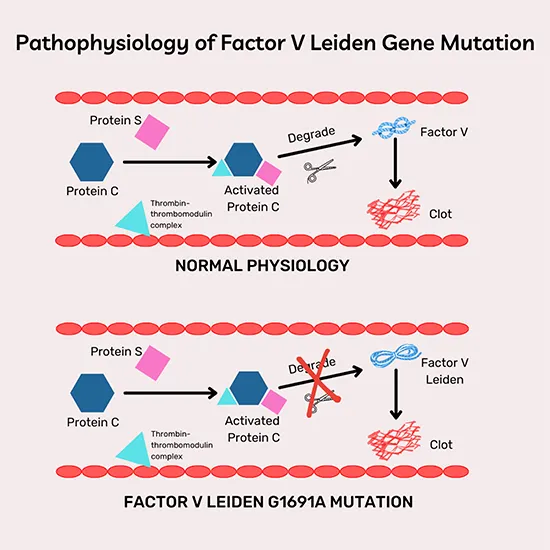 Factor V Leiden Mutation Analysis Test- Ganesh Diagnostic