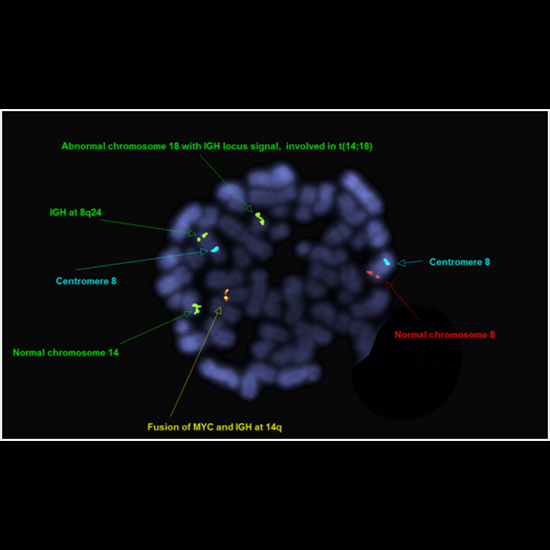 Fish, Follicular Lymphoma, IGH/BCL2, T(14:18) Test Cost in Delhi | GDIC