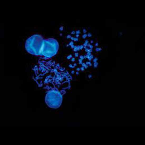 Fish for hematological Malignancies Whole Blood/Bone Marrow Test | GDIC