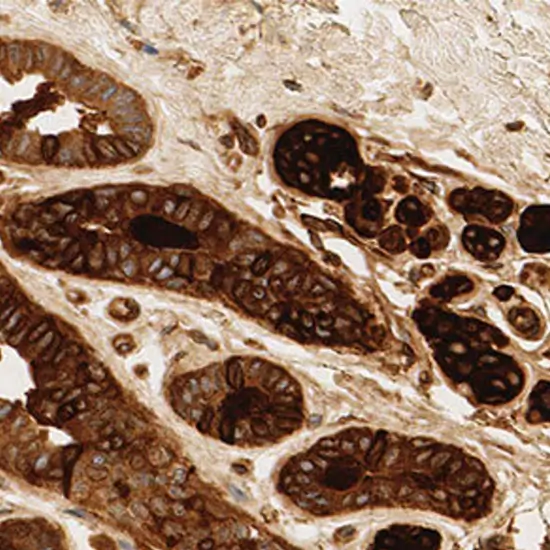 Immunohistochemistry Markers Panels Test Cost in Delhi, India | GDIC