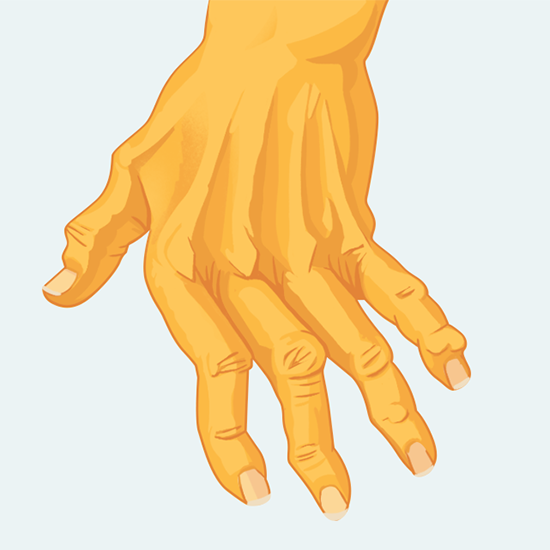 Types Of Rheumatology Tests | Price List Rheumatology Test In India ...