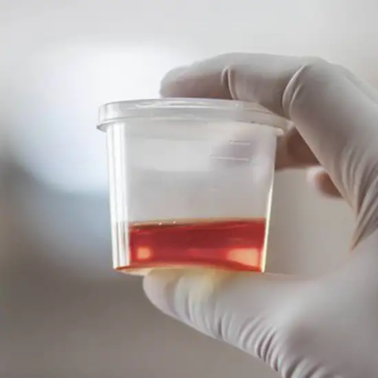 Book Hematuria (Blood in Urine) | Test Price In Delhi, India | Ganesh ...