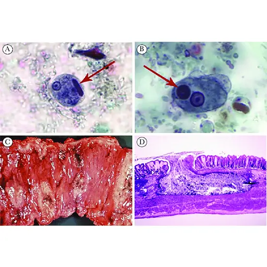 Entamoeba Histolytica (Amebiasis), Antibody, IgG Test in Delhi | GDIC