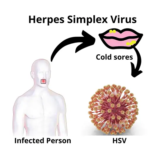Herpes Simplex Virus (HSV) 1 IgG Test in Delhi NCR, India | GDIC