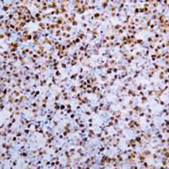 IHC - Multiple Myeloma Oncogene 1 (MUM1) Test in Delhi NCR, India | GDIC