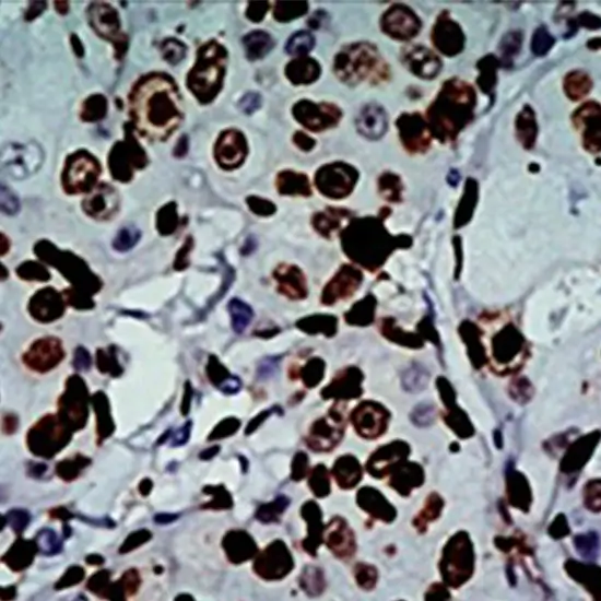 IHC: Ki-67 Marker Test in Delhi NCR, India | GDIC