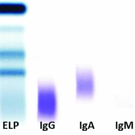Immunofixation Electrophoresis, Urine Test in Delhi NCR, India | GDIC