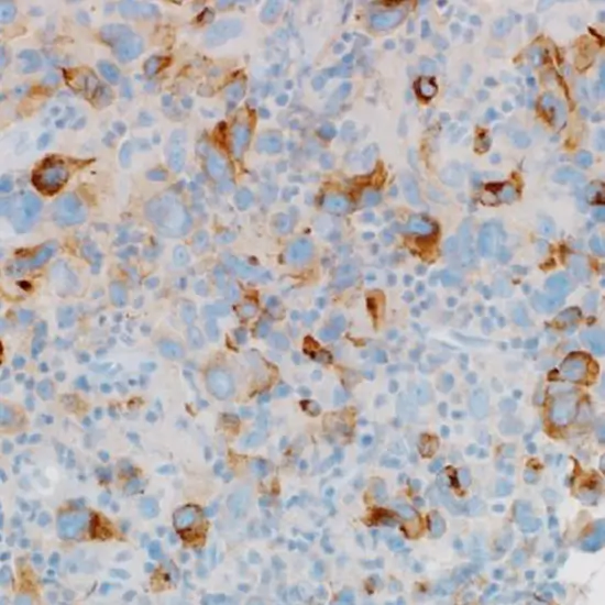 IHC - Human Melanoma Black 45 (HMB-45) Test in Delhi NCR, India | GDIC