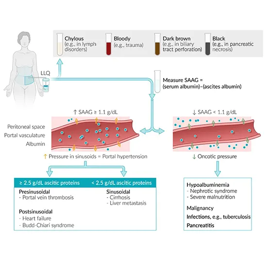 Serum-Ascites Albumin Gradient (SAAG) Test in Delhi NCR, India | GDIC