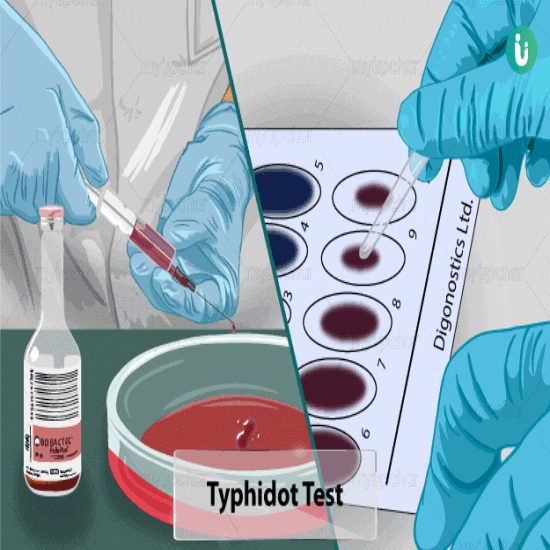 Typhidot (IgM, Igm) Antibody | Test Cost In Delhi | Price Near Me ...