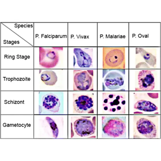 Malarial Parasite Identification Test in Delhi NCR, India | GDIC