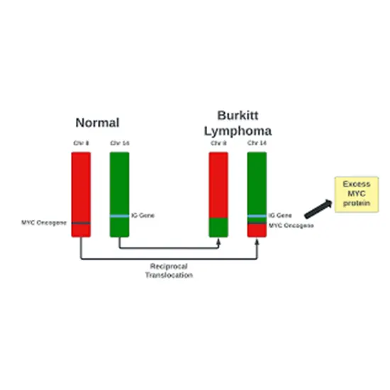 Burkitt Lymphoma-Translocation 8/14 Test in Delhi NCR, India | GDIC