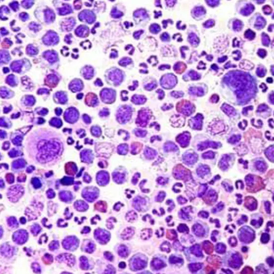 Chromosome Analysis, Leukemic Blood Test in Delhi NCR, India | GDIC