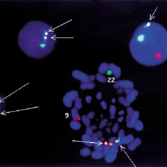 Chronic Myeloid Leukemia-FISH BCR-ABL Dual probe Test | GDIC