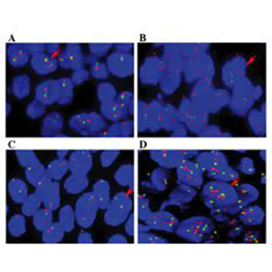 FISH, EGFR Gene Amplification, Breast Cancer Test | GDIC